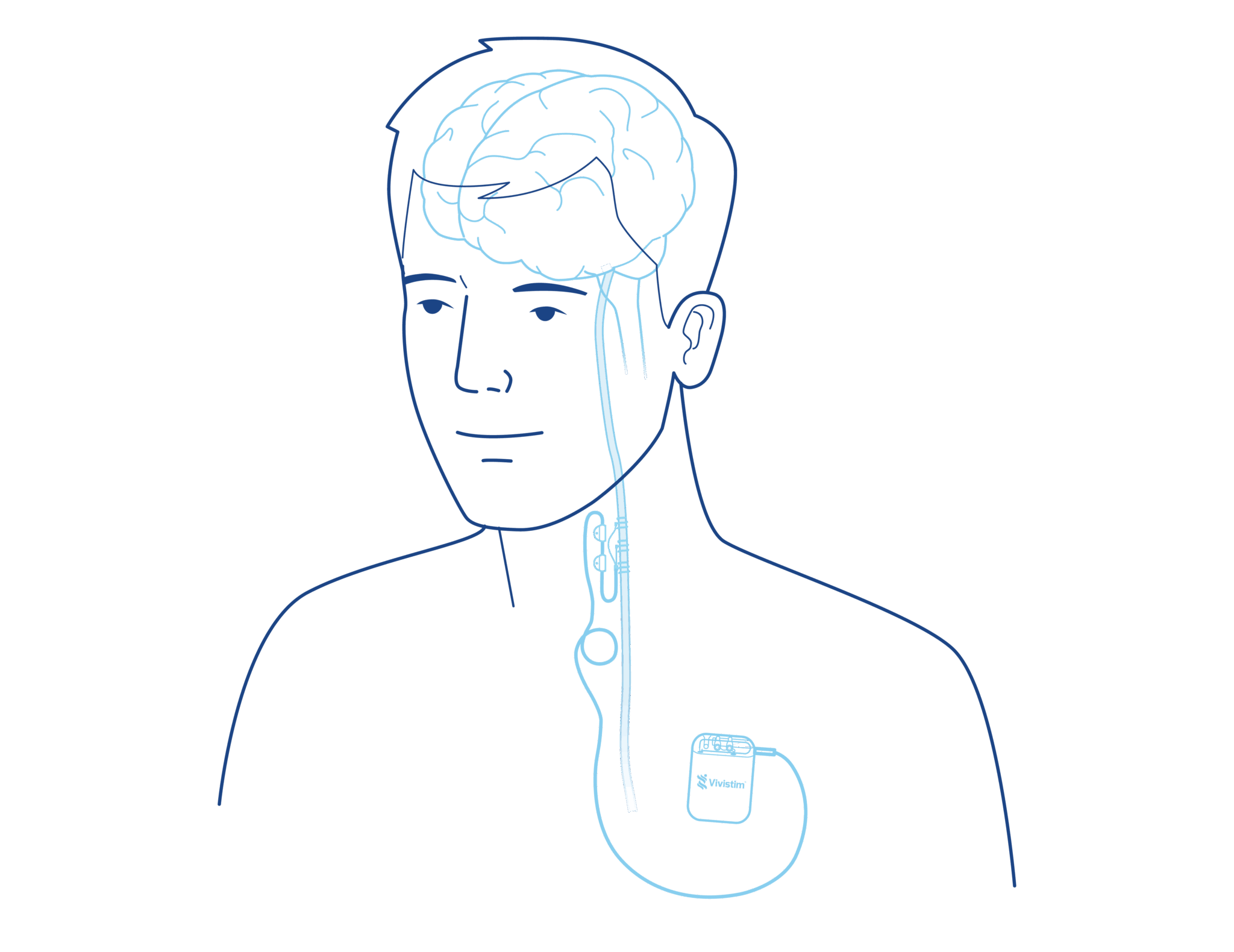 Vivistim Therapy – HARTZ Physical Therapy