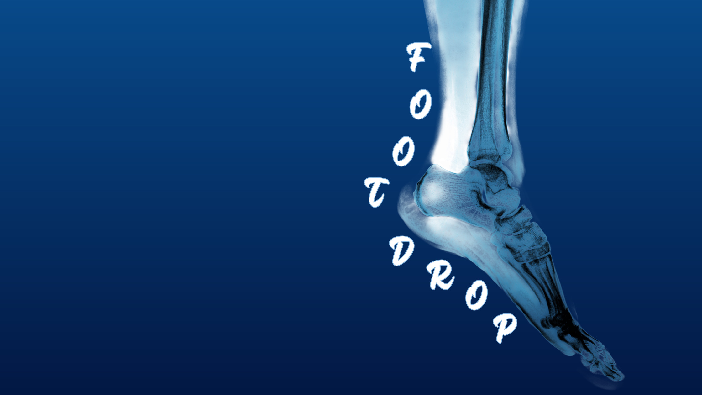 Foot Drop Doesn't Have to Slow You Down - HARTZ Physical Therapy